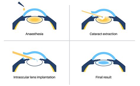 Cataract Surgery A Step By Step Guide Vision Clinic Sydney