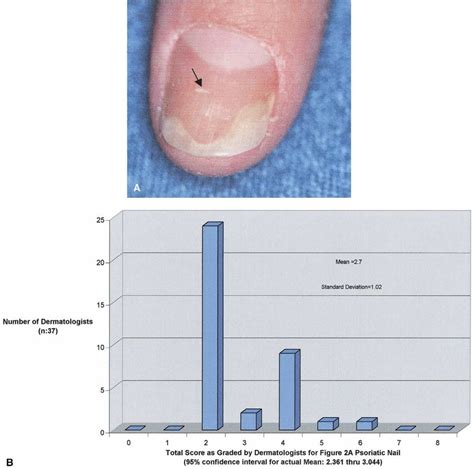 A Example Of Scoring Mild Nail Psoriasis Using The Napsi Grading Download Scientific Diagram