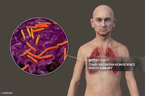 Cavernous Tuberculosis Illustration High Res Vector Graphic Getty Images