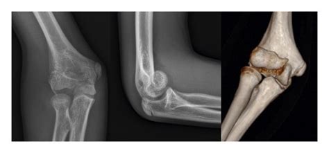 Patient Number 4 Preoperative X Rays And Ct Scan Type Ivmckee