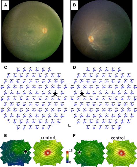 Fundus Photographs Multifocal Erg Waveforms And Multifocal Erg Download Scientific Diagram