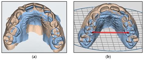 Effects Of Froggy Mouth Appliance In Pediatric Patients With Atypical