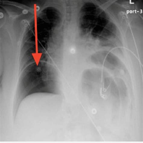 Posteroanterior Chest X Ray At The Time Of Gastric Perforation