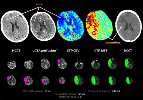 Ct Perfusion Ctp Stroke Manual