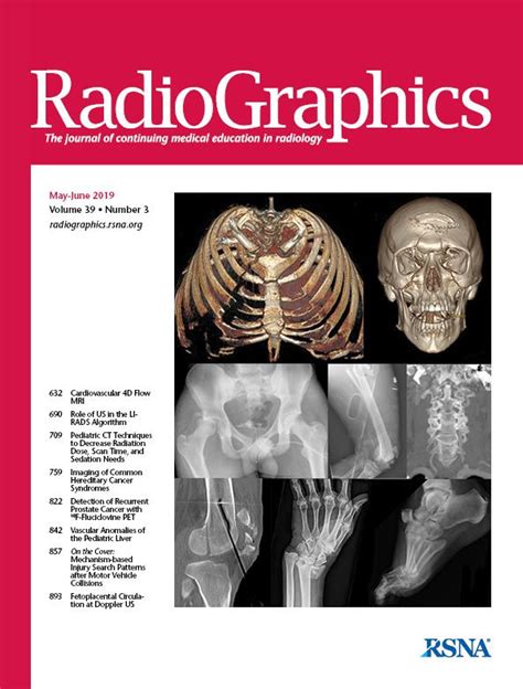 Cavernous Sinuses Are Paired Interconnected Venous Plexuses Situated In The Floor Of The Middle