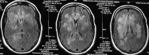 Mri Brain With T2‑weighted Images Download Scientific Diagram