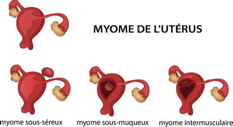 Fibrome Causes Symptômes Et Traitements Information Hospitalière Lexique Et Actualité Du