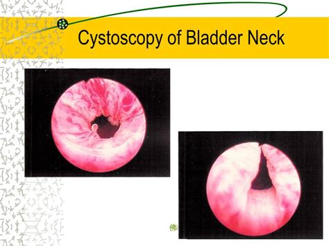 Ppt Anatomy Of Lower Urinary Tract Powerpoint Presentation Free