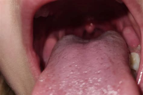 5 Year Old Cutting Molars Wont Brush Scrolller
