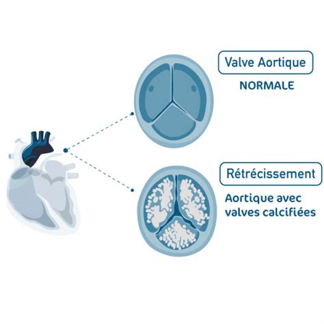 Rétrécissement Aortique Chu De Bordeaux