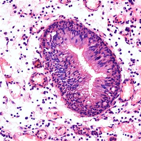 Epithelial Hyperplasia Within A Crypt Of The Sinus Mucosa He Stain