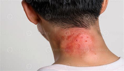 Detailed Shot Of Allergic Contact Dermatitis On The Back Of The Neck