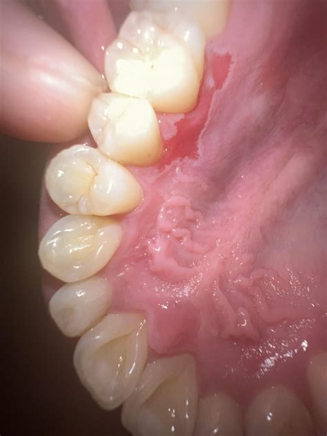 Hi Everyone 26m And Noticed Yesterday That The Gums On The Back Of My