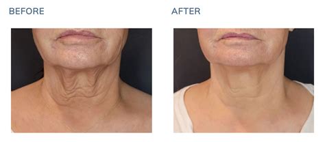 Sofwave Wrinkle Reduction Marc Gastonia Nc Beauty And Regeneration Blog Gastonia