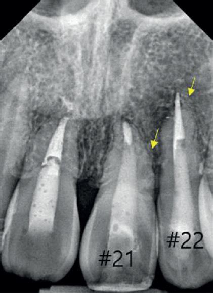 A Follow Up After 1 Year With Radiological Signs Of External