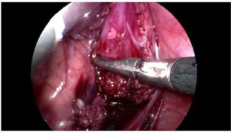 Group B Only The Posterior Part Of The Rectum Was Mobilized In A Download Scientific Diagram