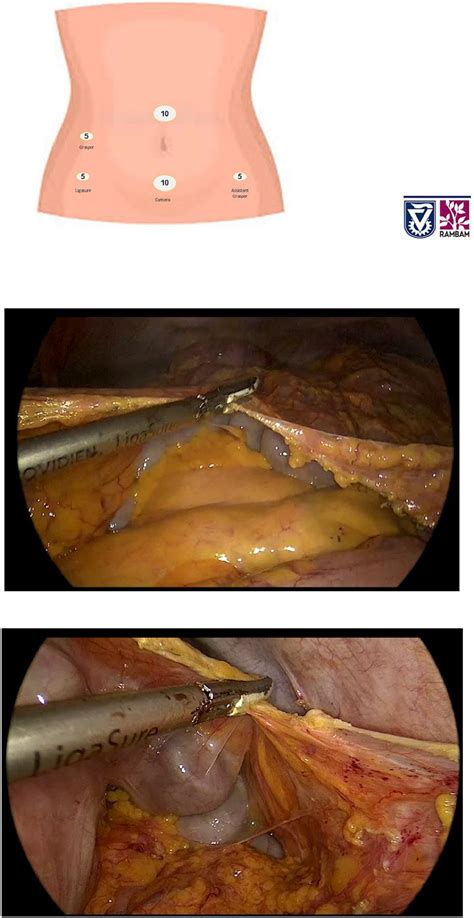 Divide And Resect A Two Piece Infra Colic Omentectomy Technique