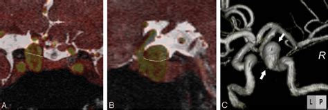 Figure 1 From Identification Of The Distal Dural Ring With Use Of