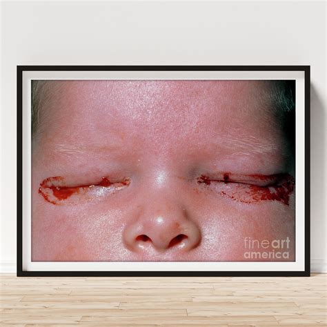 Neonatal Chlamydial Conjunctivitis