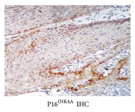 Oral Squamous Cell Carcinoma 400 X Download Scientific Diagram