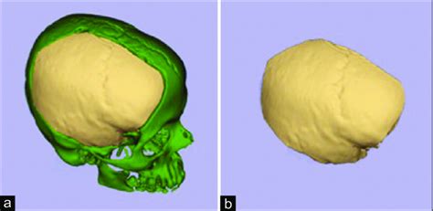 Bone Flap Area Calculation A Coregistration Of Preoperative And