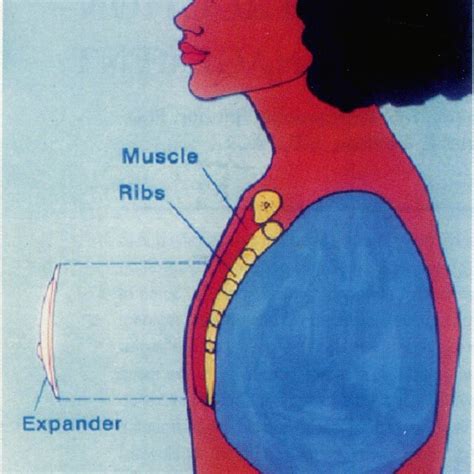 A Temporary Tissue Expander That Is Inserted Subcutaneously At The Time