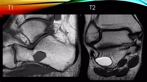 Benign Bone Tumours Pptx