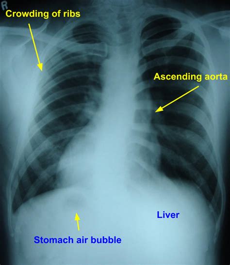 Dextrocardia And Dextroposition
