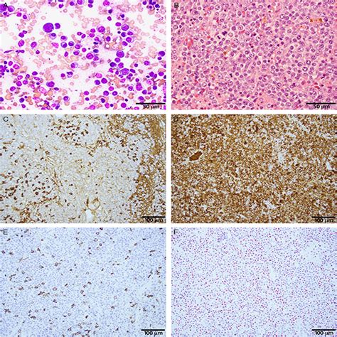 Recipient Derived Ebv Positive Monomorphic Plasmacytoma Type Journal Of Pediatric