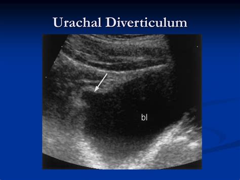 Ppt Pediatric Umbilical Abnormalities Powerpoint Presentation Free