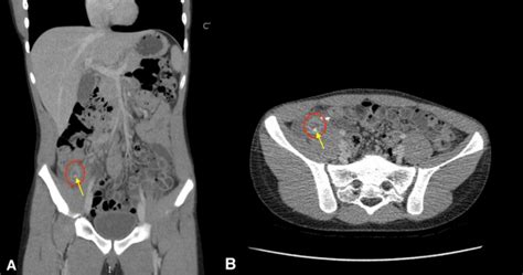 Stumped By A Case Of Appendicitis After Appendectomy Ochsner Journal