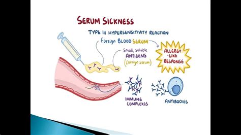 Serum Sickness Youtube