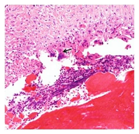 Multinuclear Giant Cells In The Two Regions Denoted By Rectangles In Download Scientific