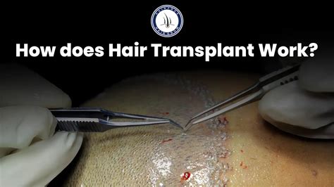 How Do Hair Transplants Work Everything You Need To Know