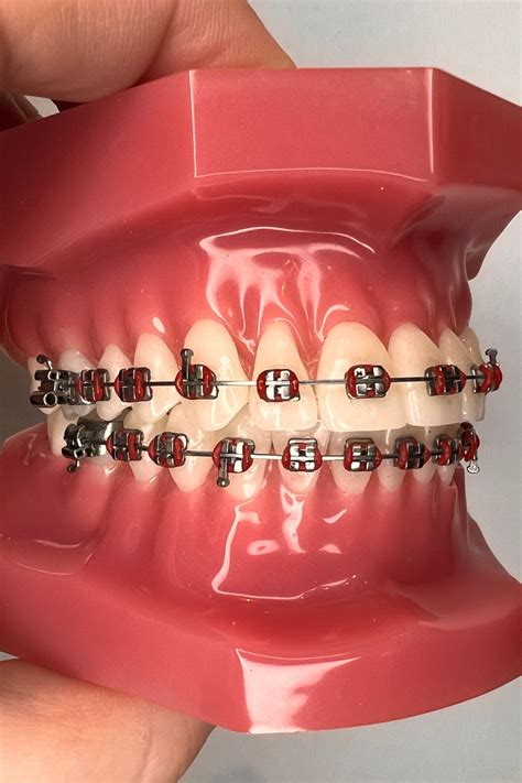 Red Braces Bands Discover 20 More Red Braces Color Combos Braces
