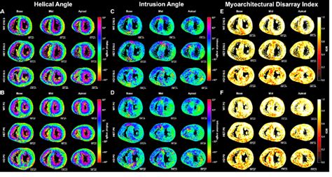 Quantification Of Myocyte Orientation Via Helical And Intrusion