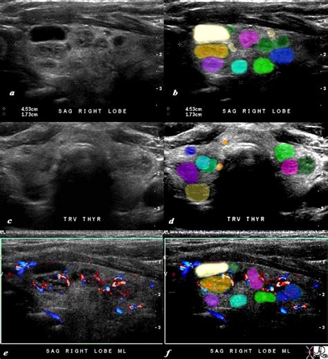 Goiter Multinodular Non Toxic The Common Vein