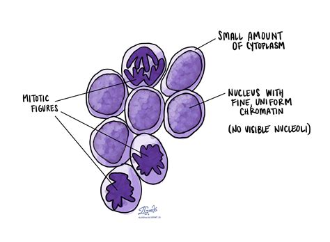 Small Cell Lung Cancer Symptoms