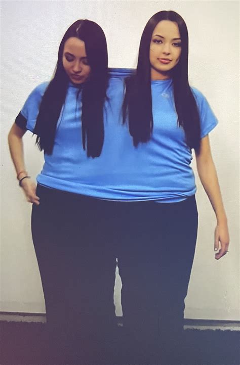 Pin By Jonathan Jenkins On Conjoined Twins Challenge Merrill Twins