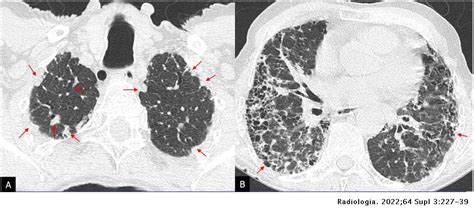 Idiopathic Pulmonary Fibrosis Radiología English Edition