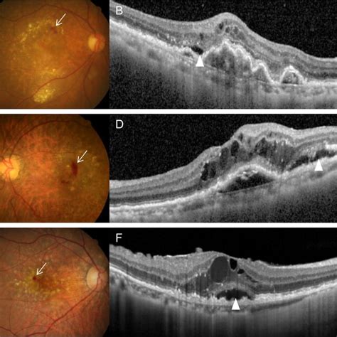 A Even After Four Intravitreal Injections The Intraretinal Cyst In