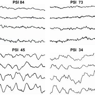 The Typical Patterns And The Characteristic Changes Of EEG When PSI Download Scientific Diagram