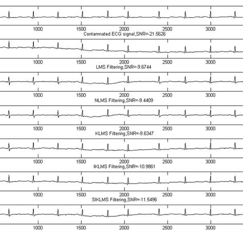 A Ecg Signalbcontaminated Ecg Signal With Baseline Wander