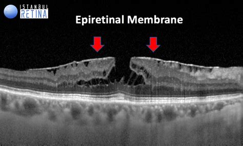 Lamellar Macular Hole And Macular Pseudohole Oct Club