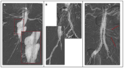 Co2 Angiography In The Standard And Complex Endovascular Repair Of The