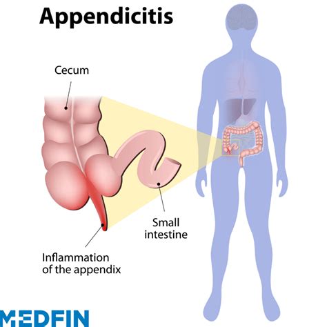 Appendix Appendicitis And Appendectomy Commonly Asked Questions