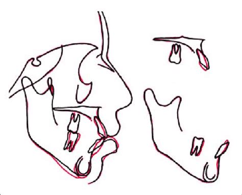 Superimpositions Showing The Increase Of The Interincisal Angle Download Scientific Diagram