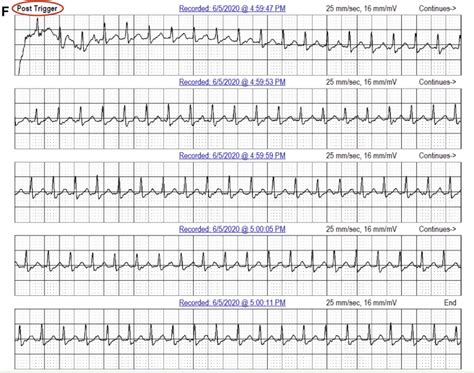 Continuous Ecg Monitoring Versus Mobile Telemetry A Comparison Of