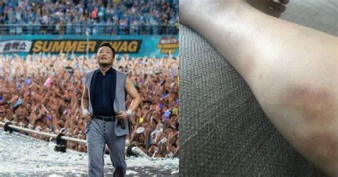 싸이가 공연 중 바늘로 종아리를 찔러야 했던 이유는