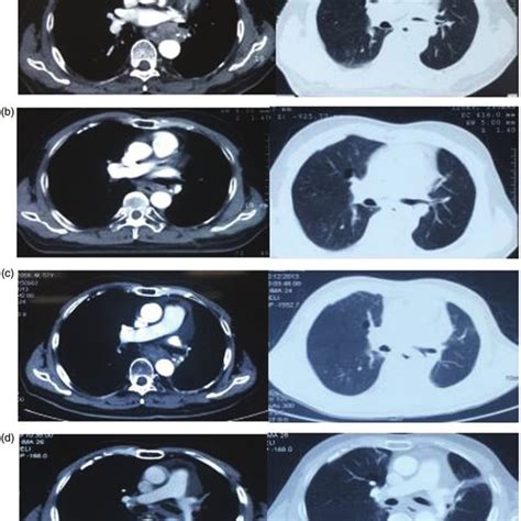 Histology Images In A Show Moderately Differentiated Squamous Cell